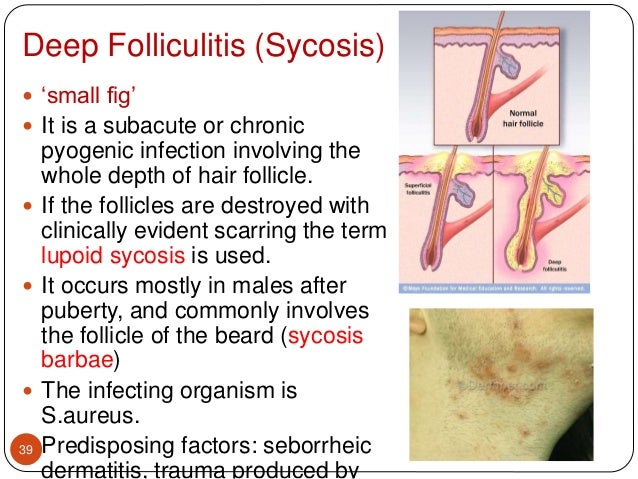 Staphylococcal & streptococcal skin infections
