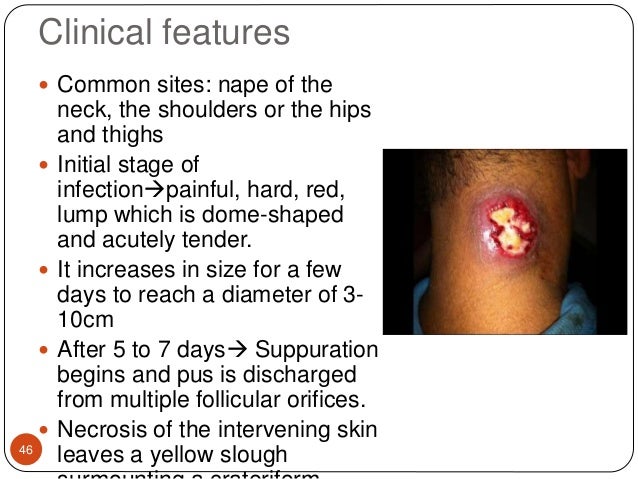 Staphylococcal & streptococcal skin infections