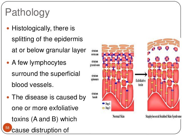 Staphylococcal Scalded Skin Syndrome Histology