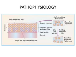 Staphylococcal Scalded Skin Syndrome Histology
