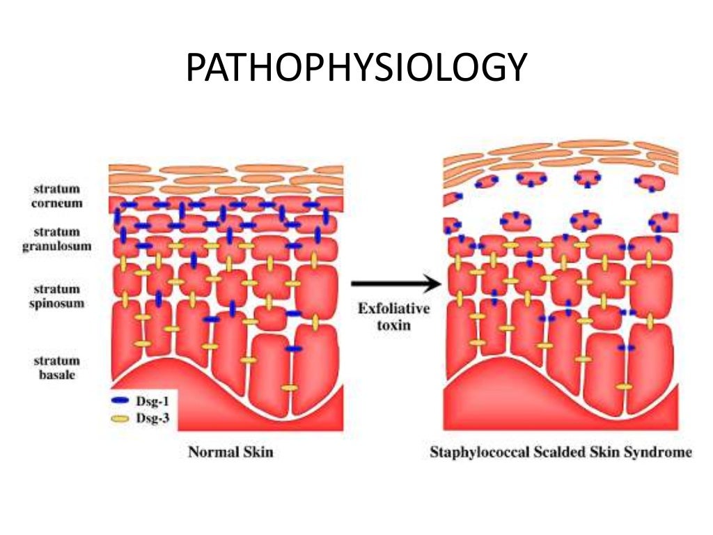 Staphylococcal scalded skin syndrome