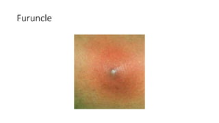 Staphylococcus | PPTX