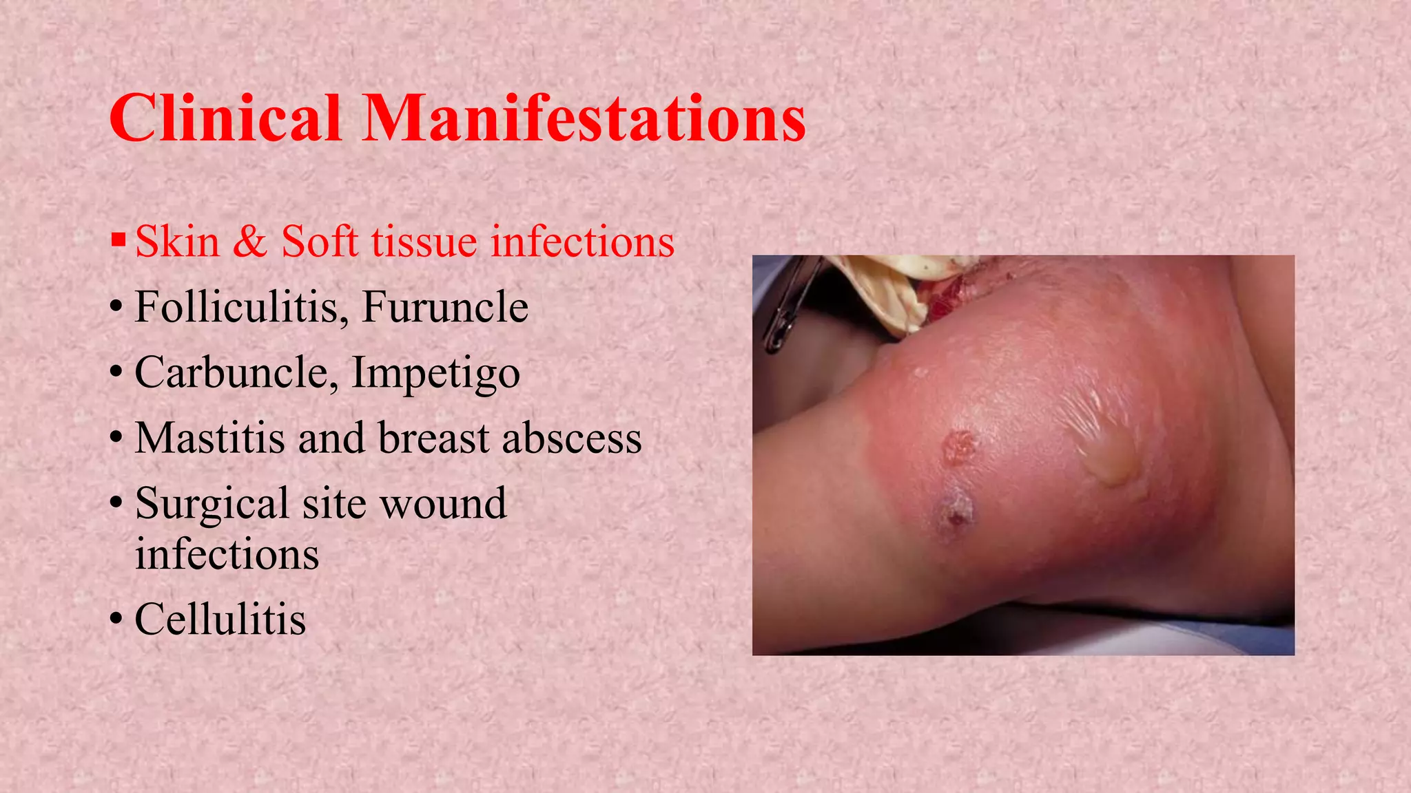Staphylococcus | PPTX