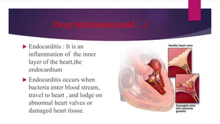 Staphylococcus aureus | PPTX