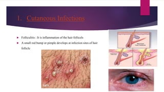 Staphylococcus aureus | PPT