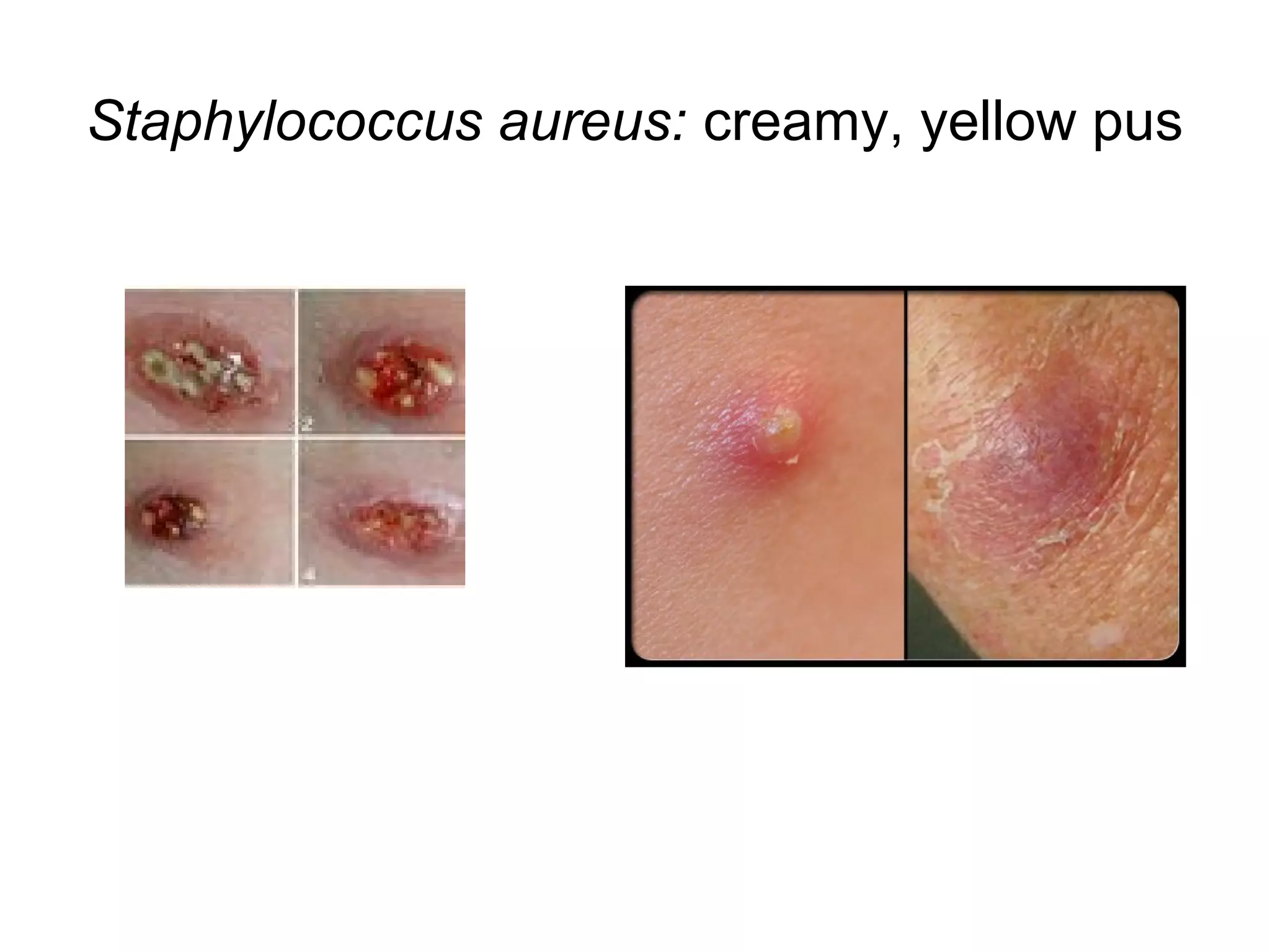Staphylococcus streptococcus bacteriological diagnosis_i | PPT