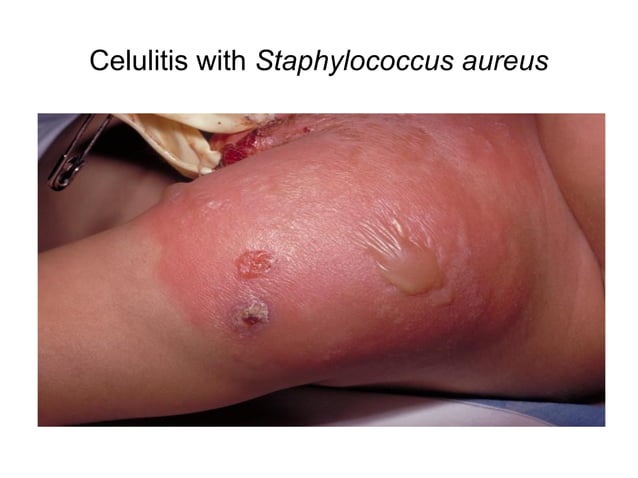 Staphylococcus streptococcus bacteriological diagnosis_i | PPT ...