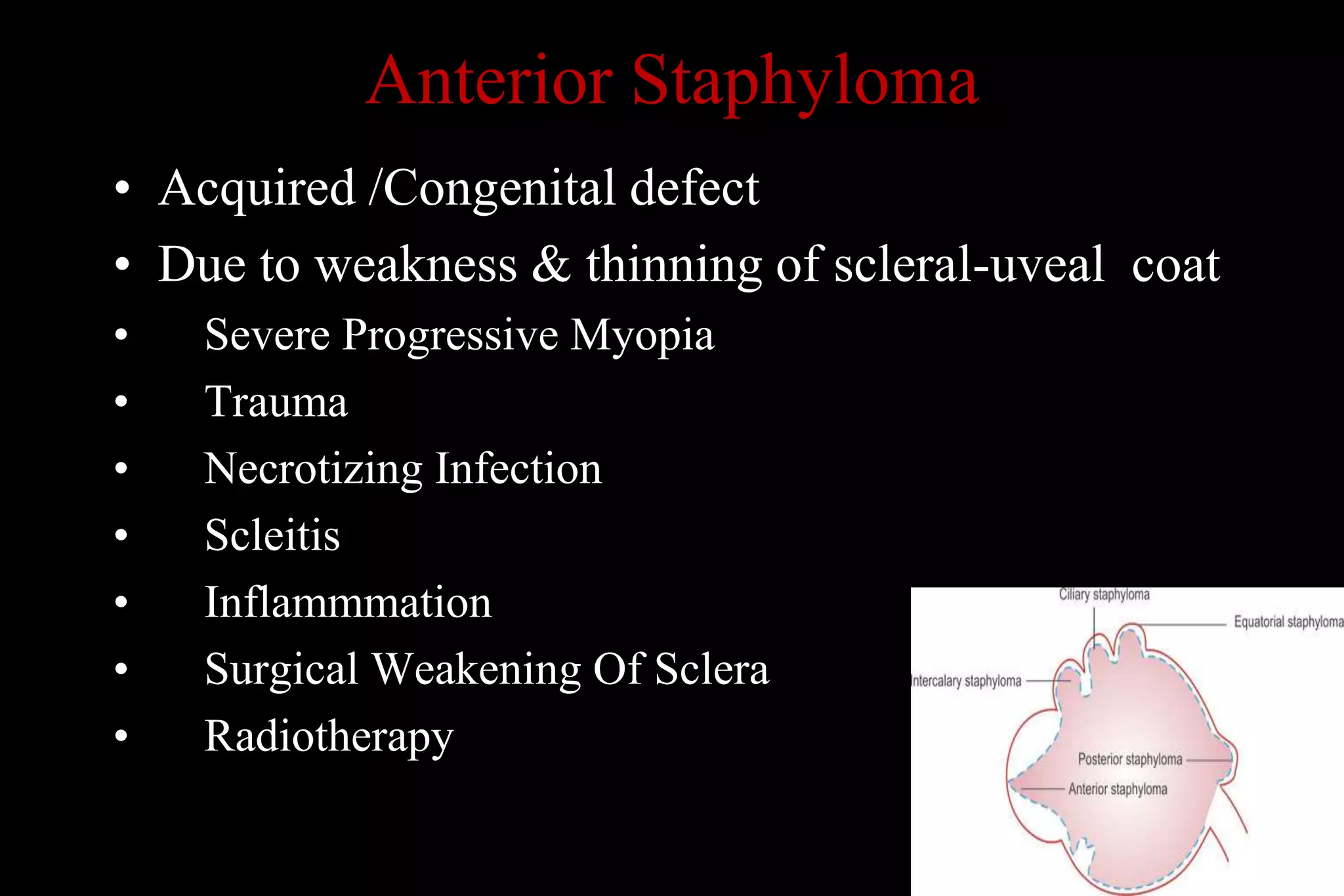 Staphyloma | PPT