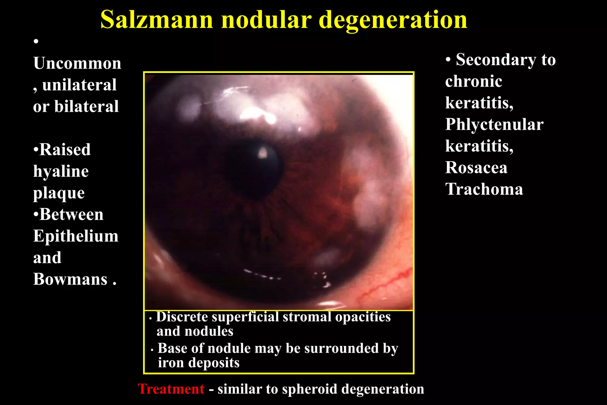 Staphyloma | PPT