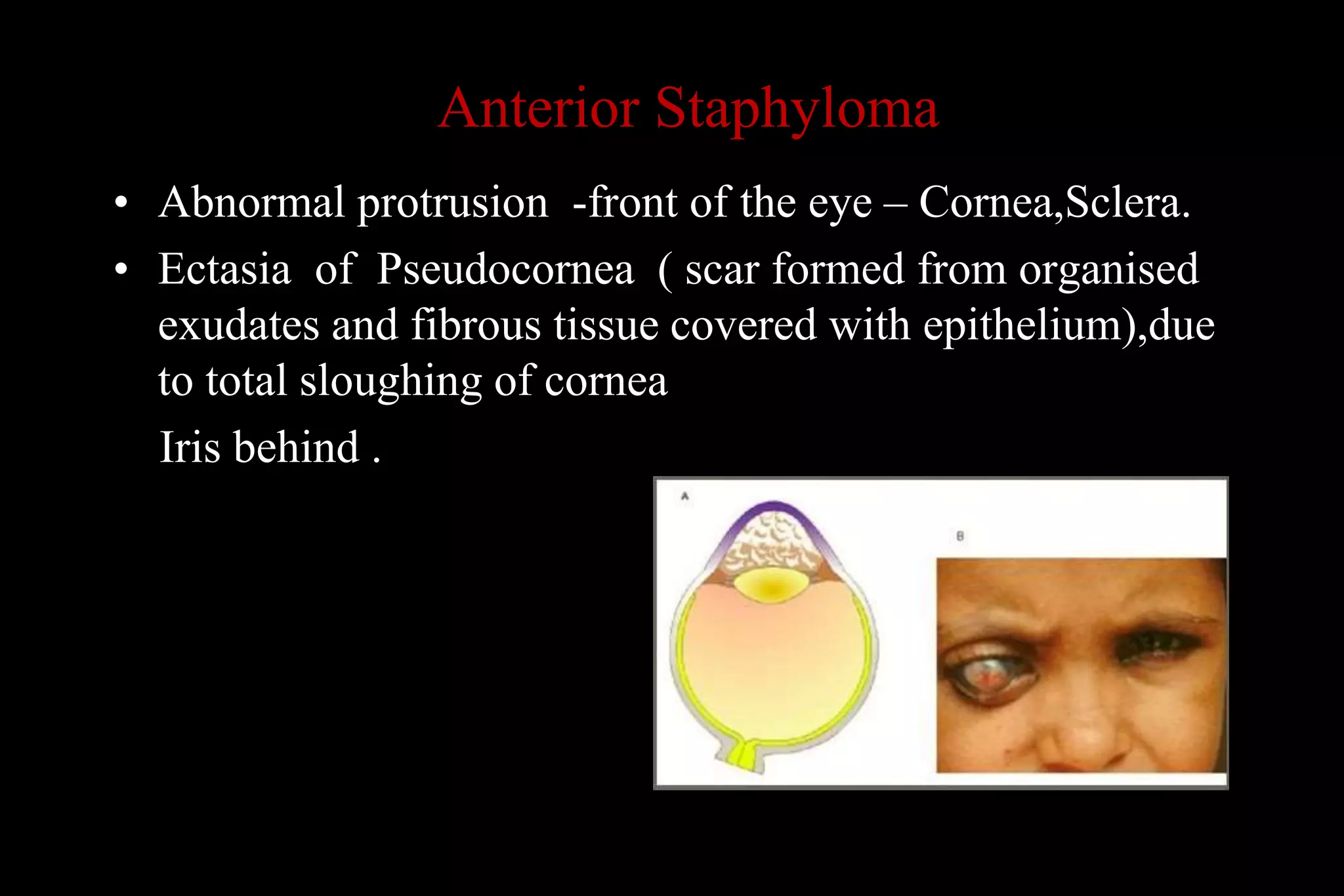 Staphyloma | PPT