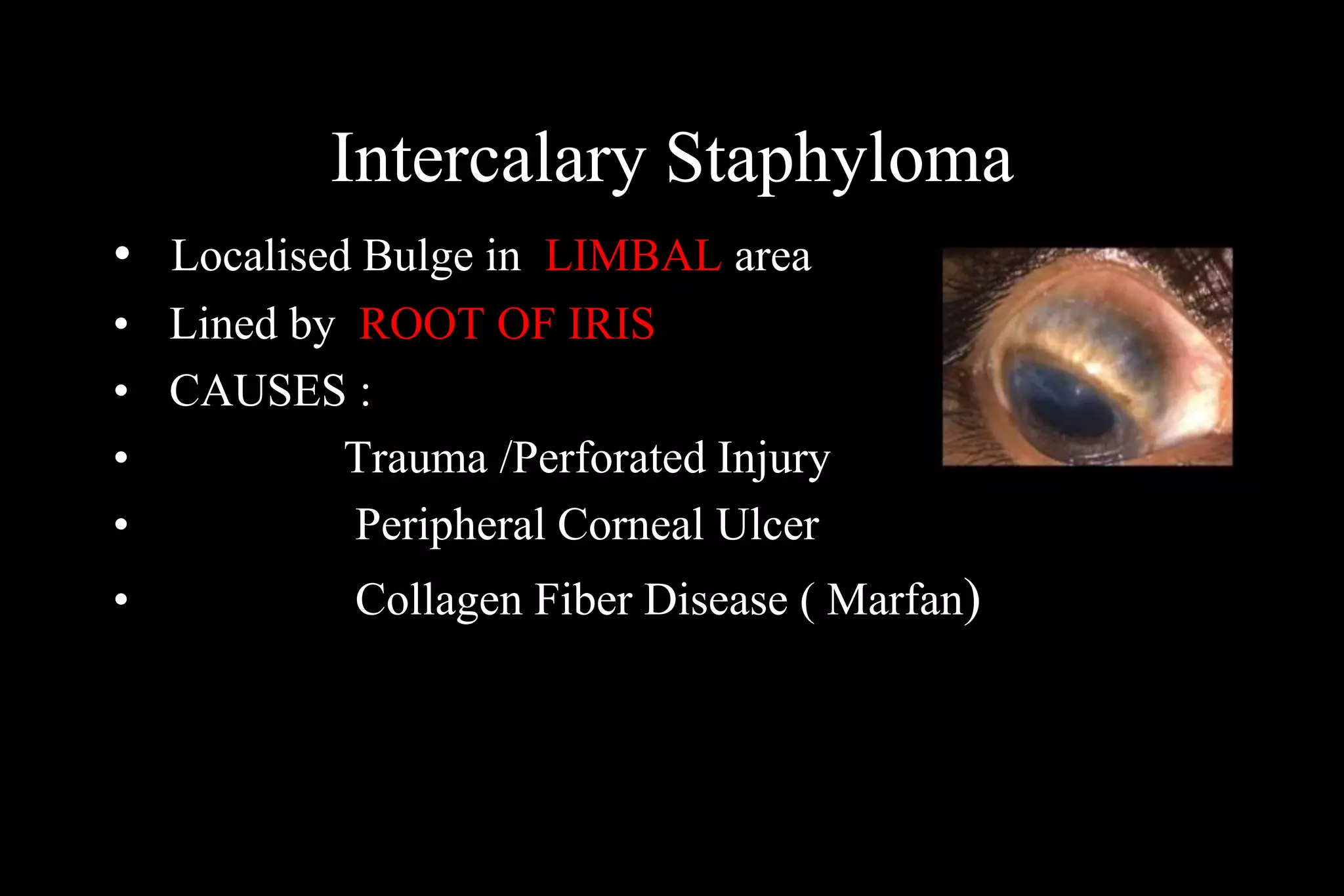 Staphyloma | PPT
