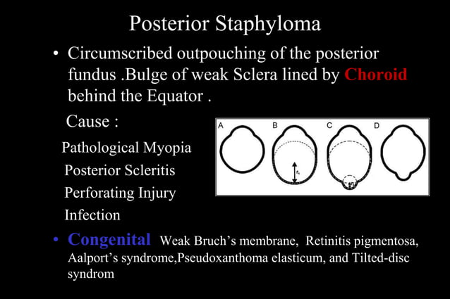 Staphyloma | PPT