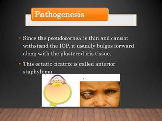 Staphylomas.ppt