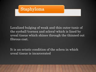 Staphylomas.ppt