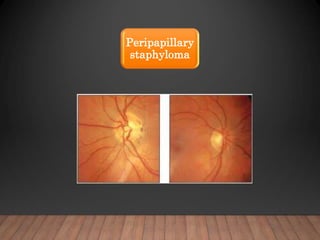 Peripapillary Atrophy Vs Staphyloma