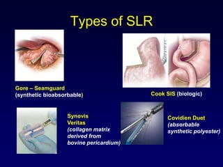 Staple line reinforcement | PPT