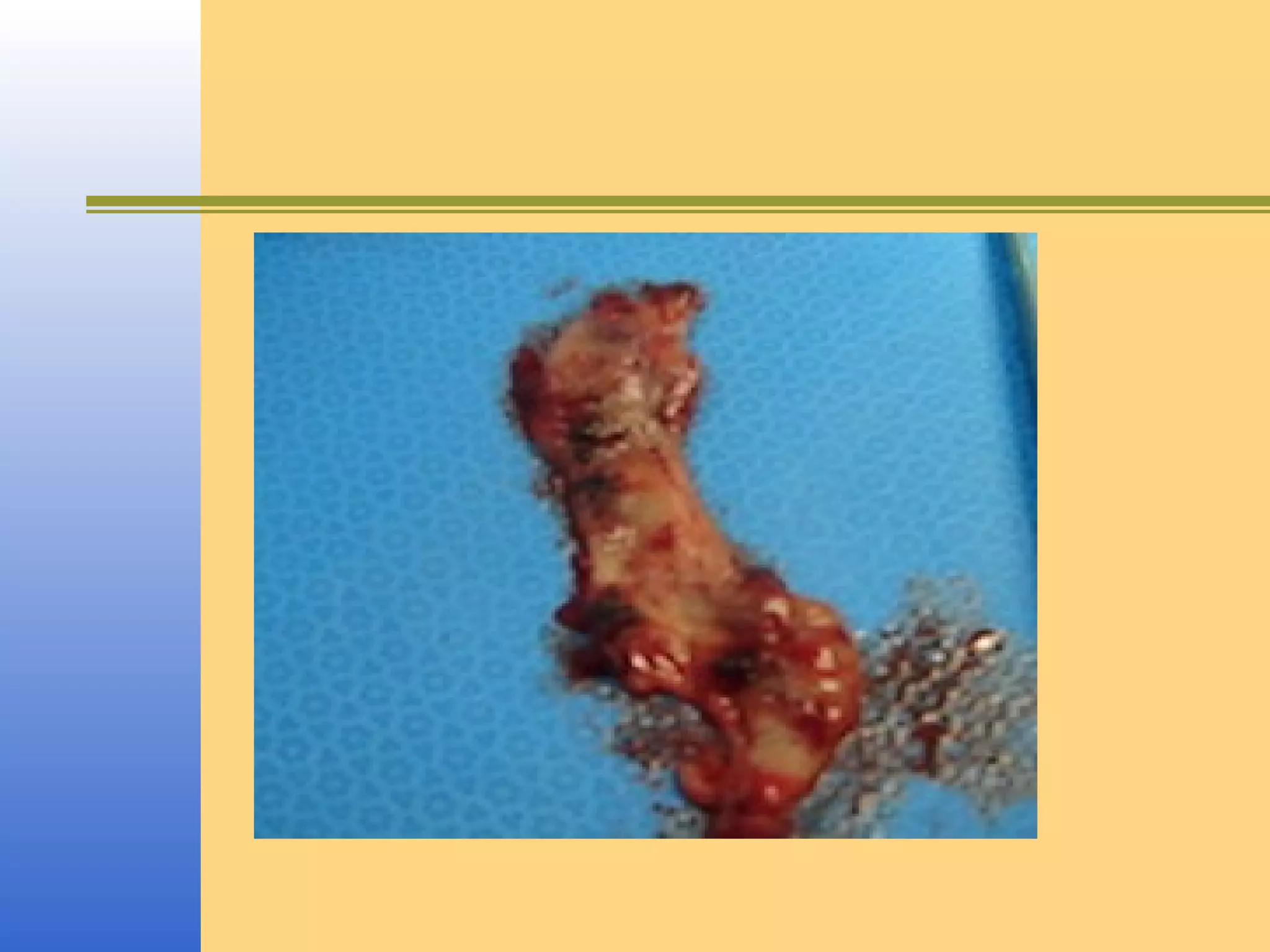 Stapler hemorrhoidectomy 3 | PPT