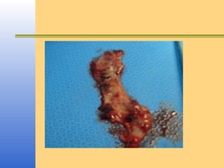 Stapler hemorrhoidectomy 3 | PPT