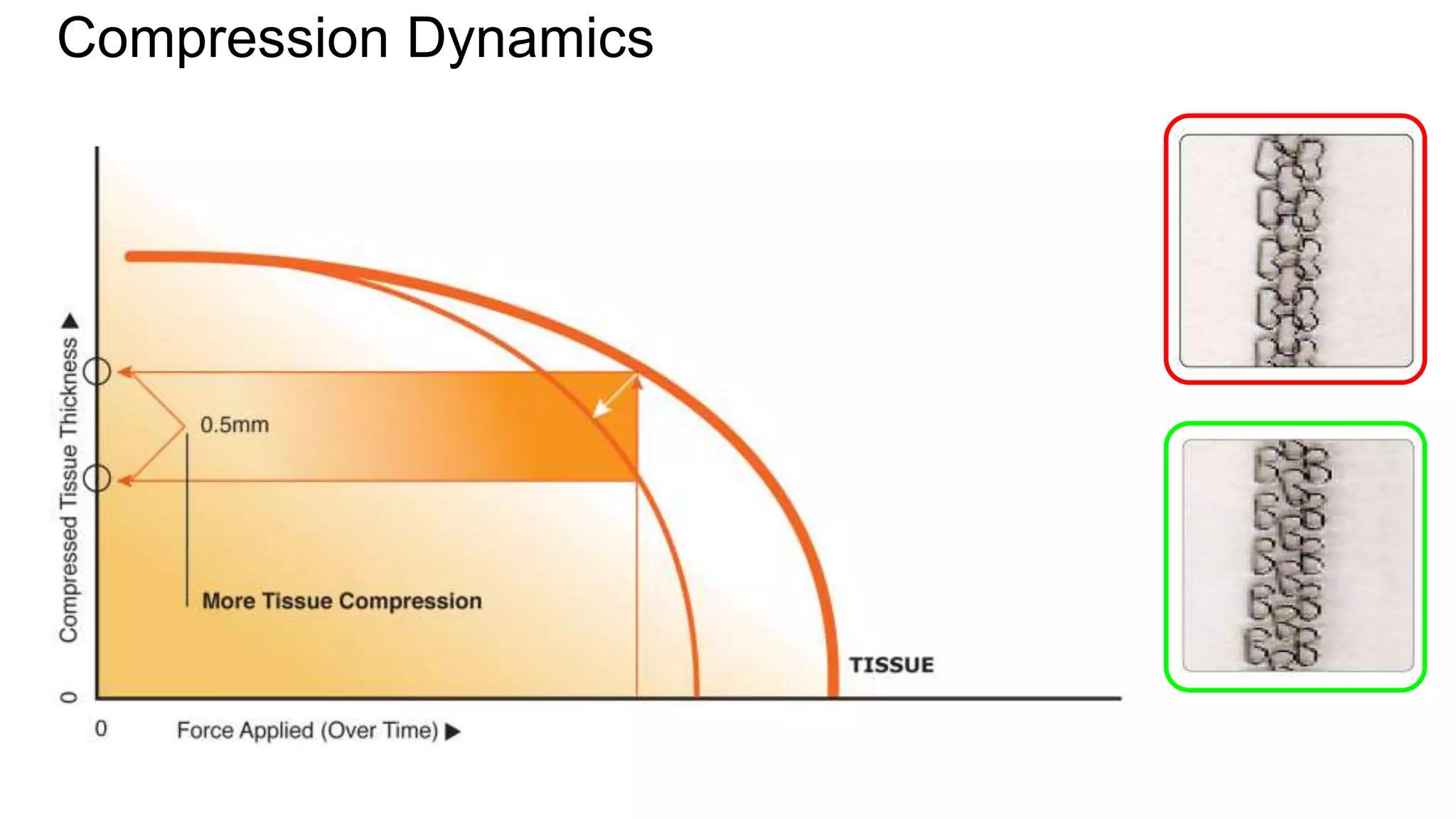 Staplers in Surgery | PPTX