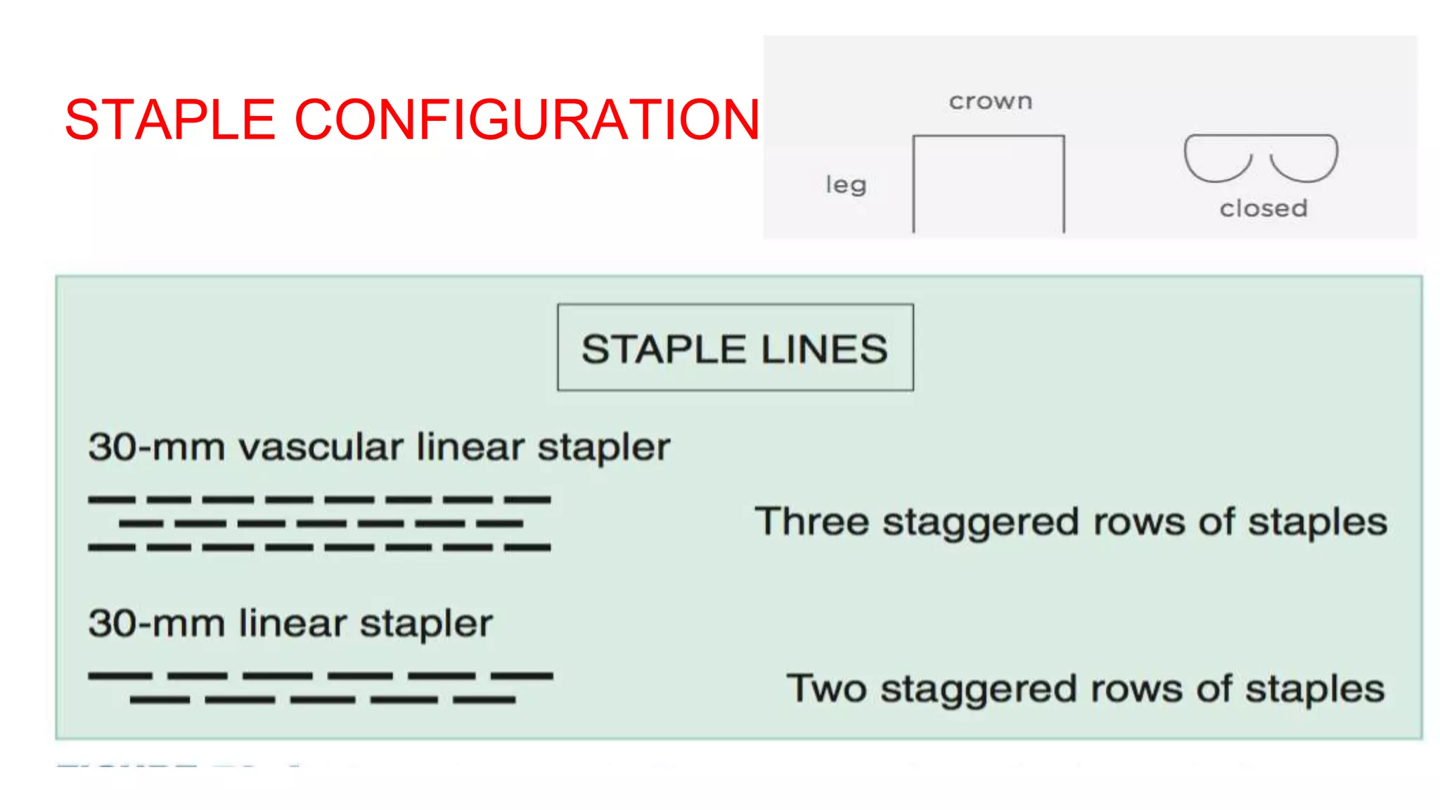 Staplers in Surgery | PPTX