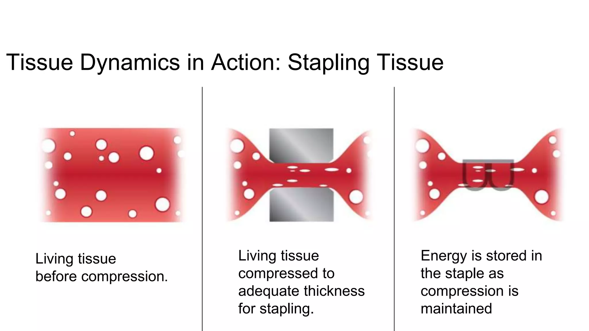 Staplers in Surgery | PPTX