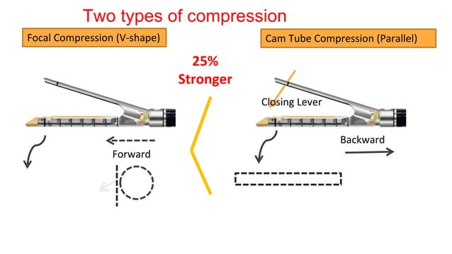 Staplers in Surgery | PPTX