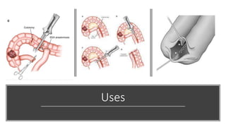 Staplers used in intestinal surgery.pptx