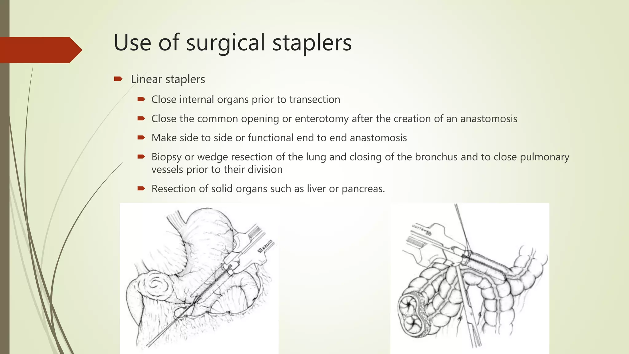 Use of Staplers in surgery | PPTX