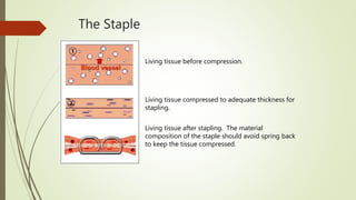 Use of Staplers in surgery | PPTX