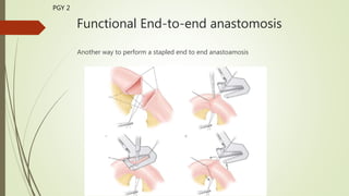 End-To-End Stapled Technique For Kono-S Anastomosis – YLEAV