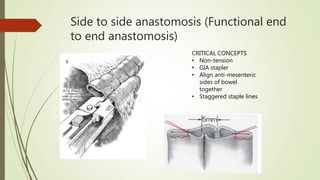 Use of Staplers in surgery | PPT