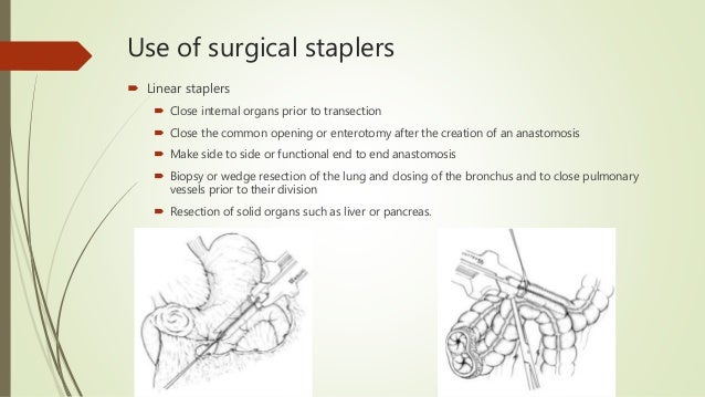 Use of Staplers in surgery