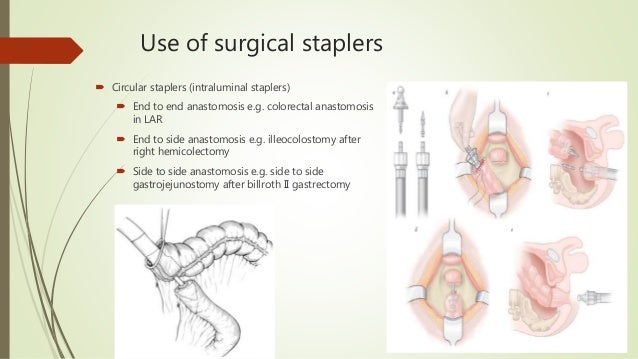 Use of Staplers in surgery