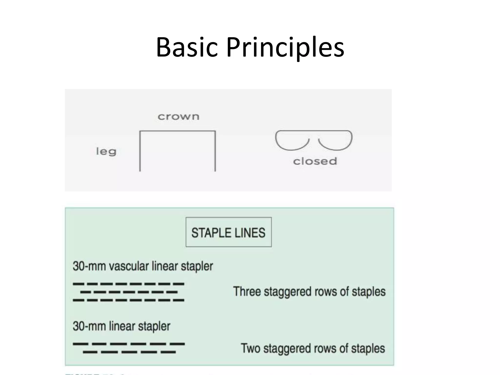 Stapling devices in surgery | PPTX