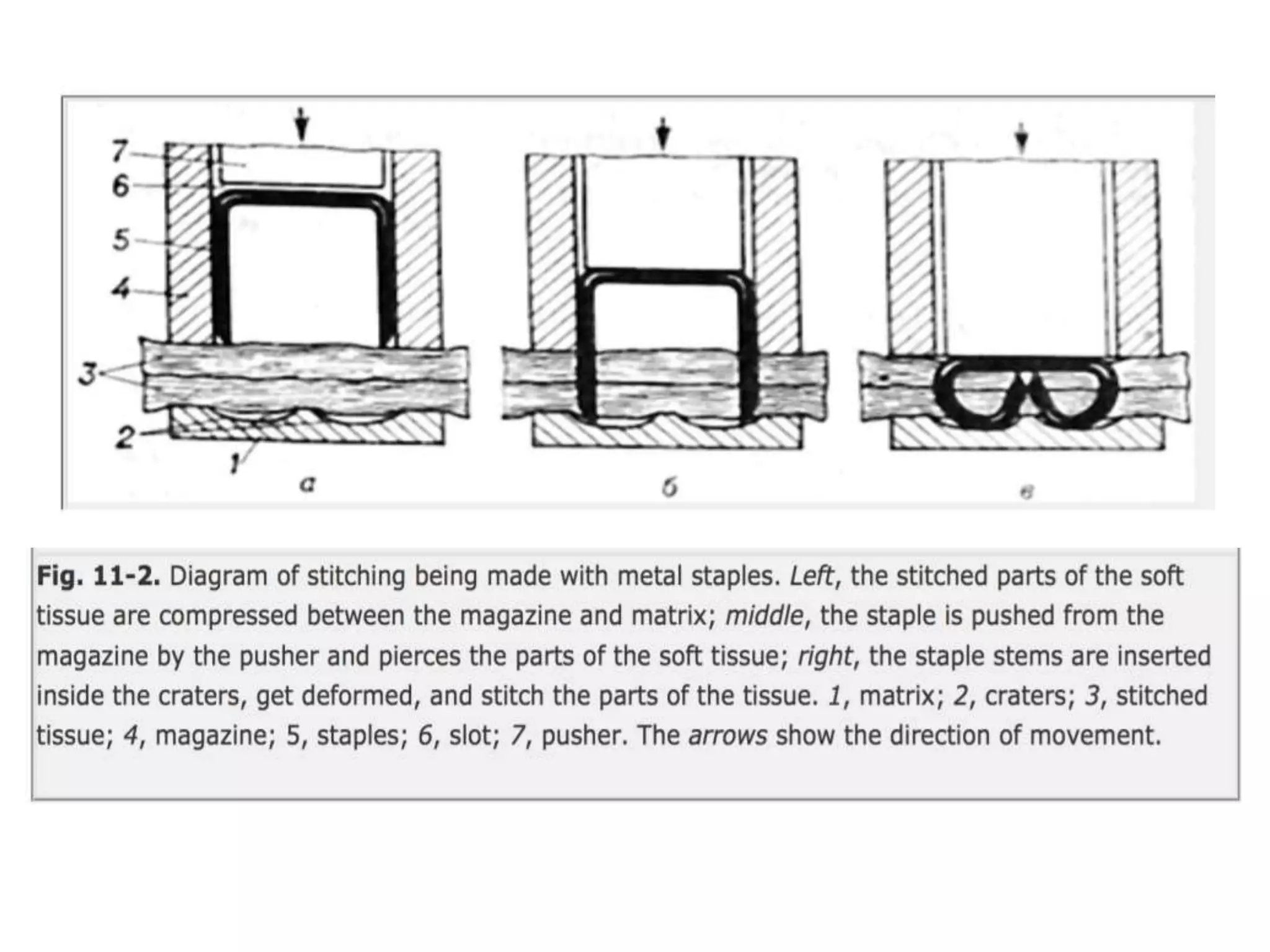 Stapling devices in surgery | PPTX