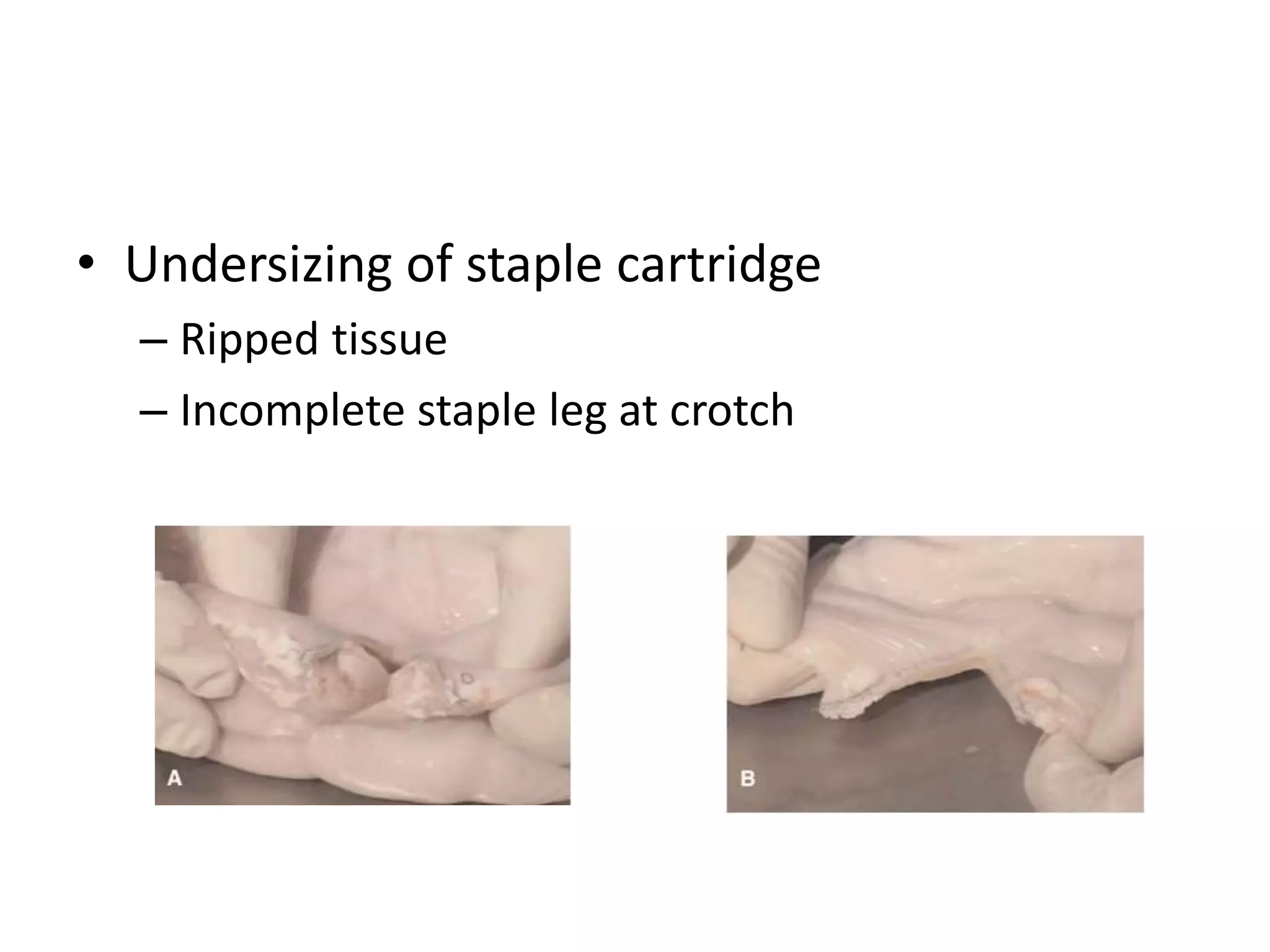 Stapling devices in surgery | PPTX