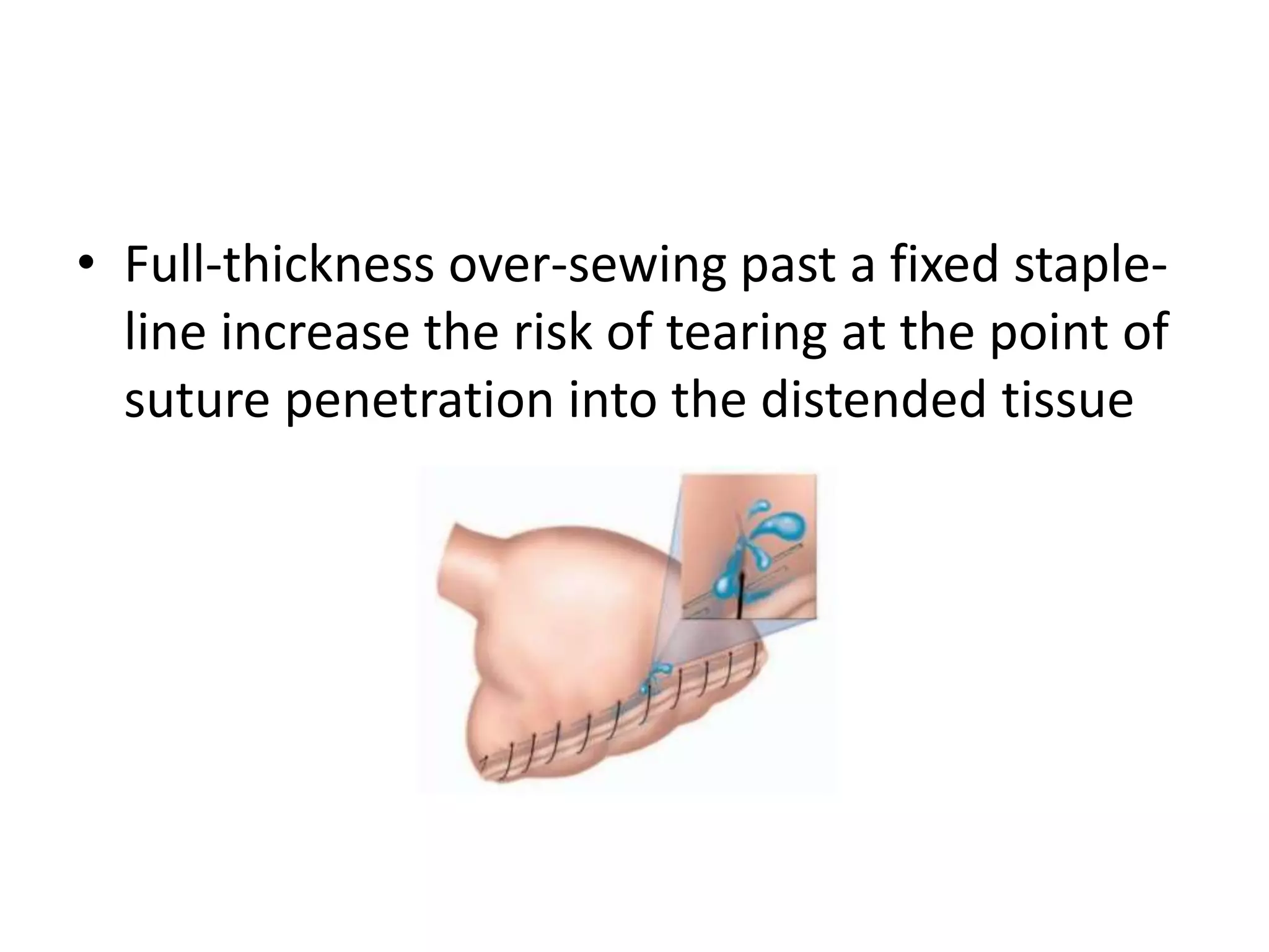 Stapling devices in surgery | PPT