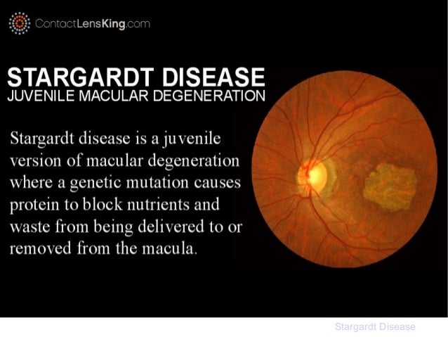 Stargardt Disease | Juvenile Macular Degeneration