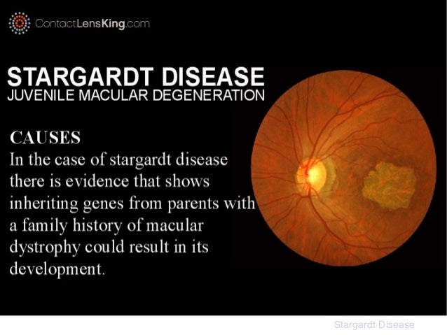 Stargardt Disease | Juvenile Macular Degeneration Stargardt Disease | Juvenile Macular Degeneration
