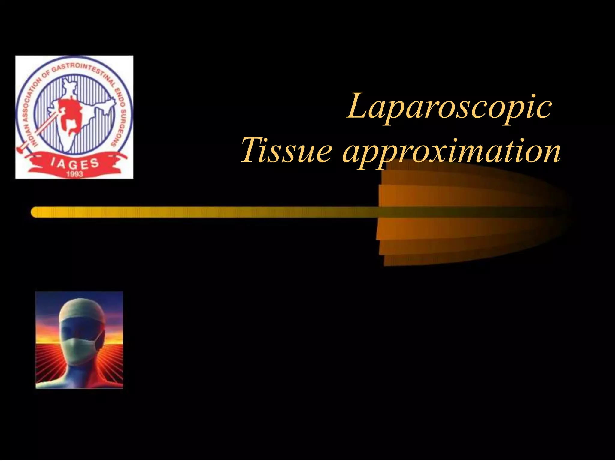 STARR procedure in ODS patients.pptx