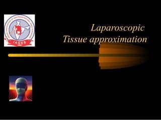 STARR procedure in ODS patients.pptx