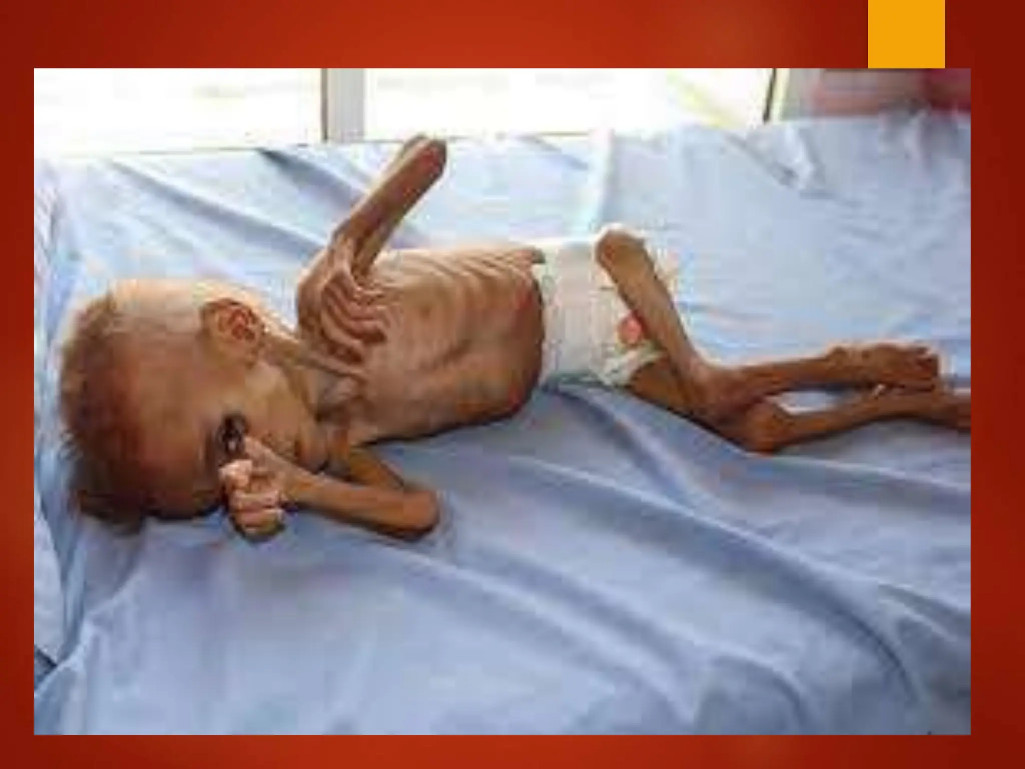 starvation.pptx community medicine environment | PPT