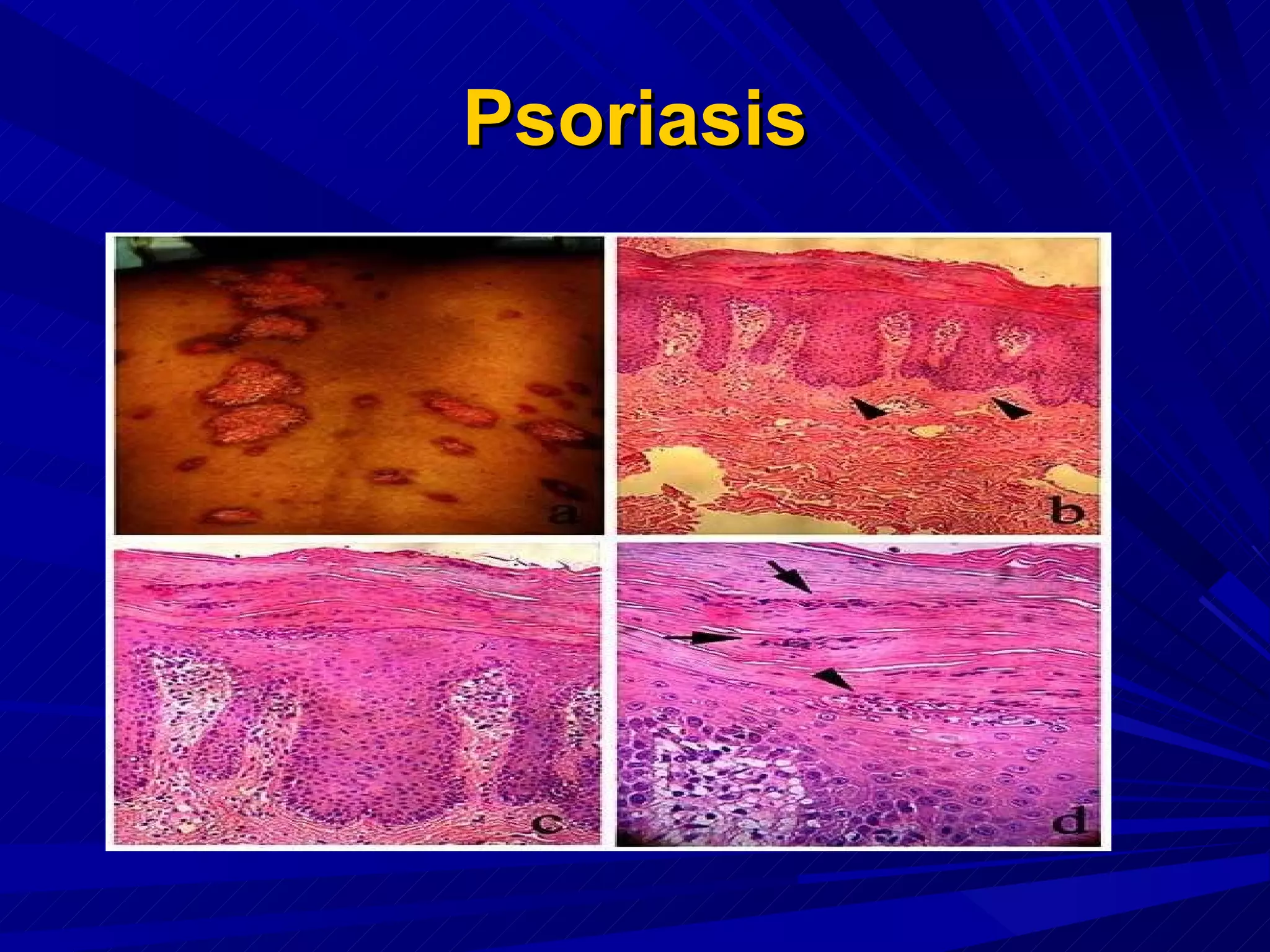 Stat3protein & immunocompetent cells in psoriasis pathogenesis | PPT