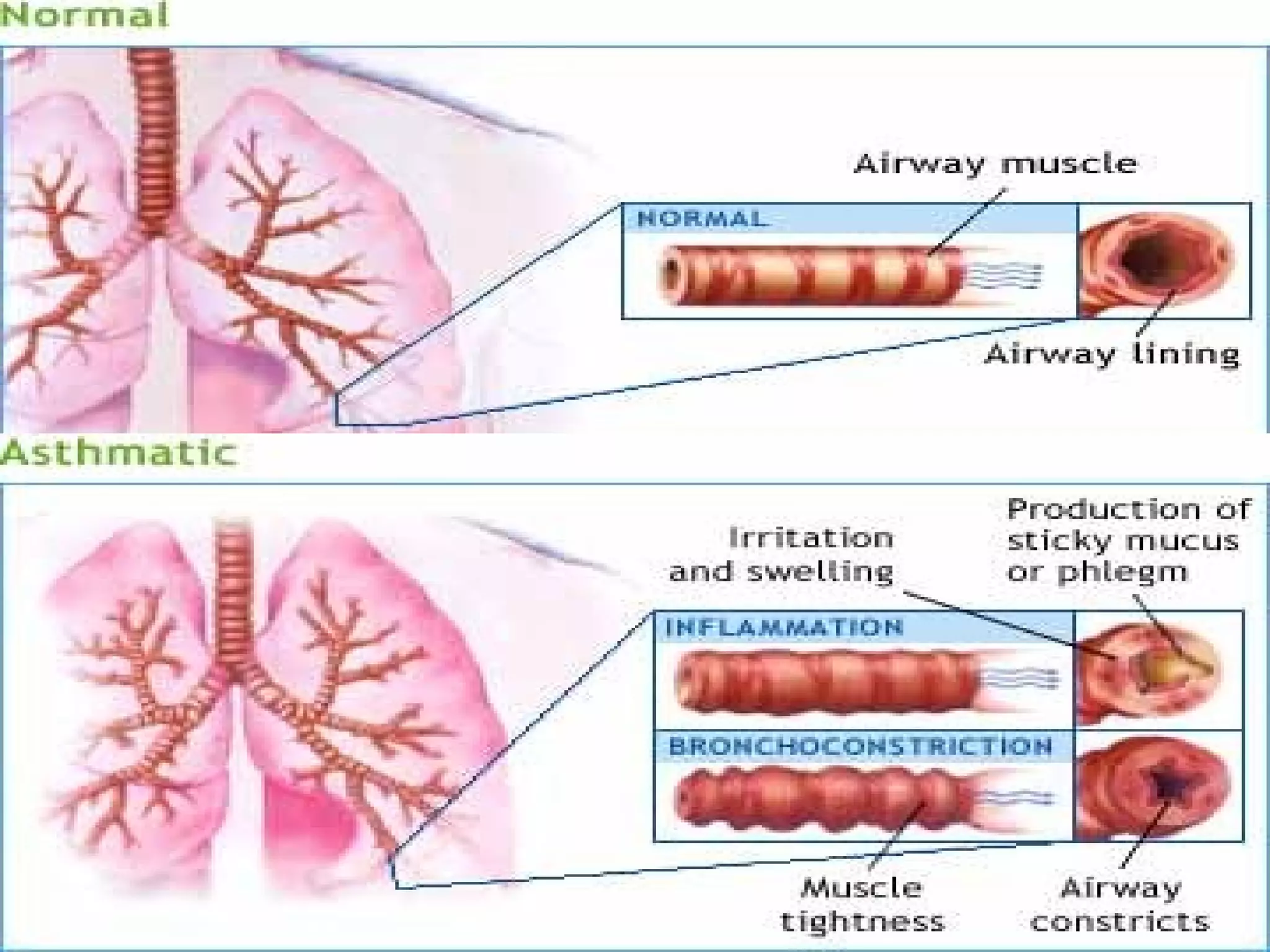 Status asthmaticus | PPT