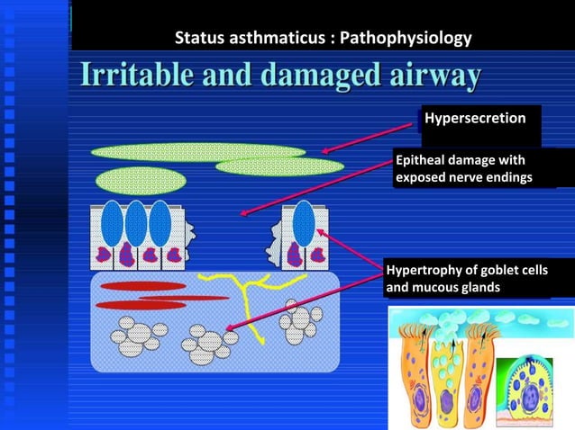 Status asthmaticus by Pushpa Raj Sharma | PPT