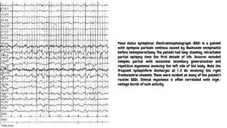 Management of Status Epilepticus | PDF