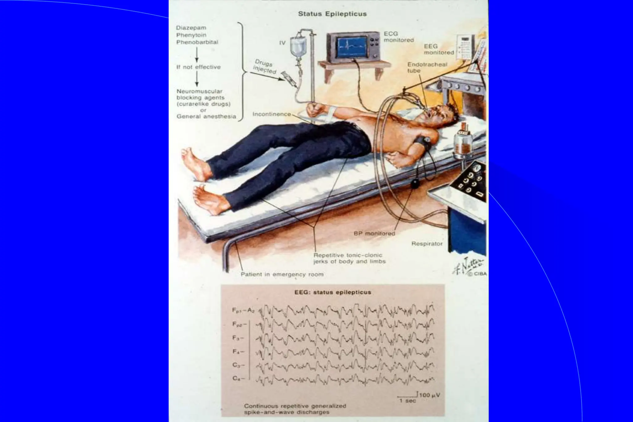 status_epilepticus_-_clinical_featurespathopysiologyand_treatmentcraig ...