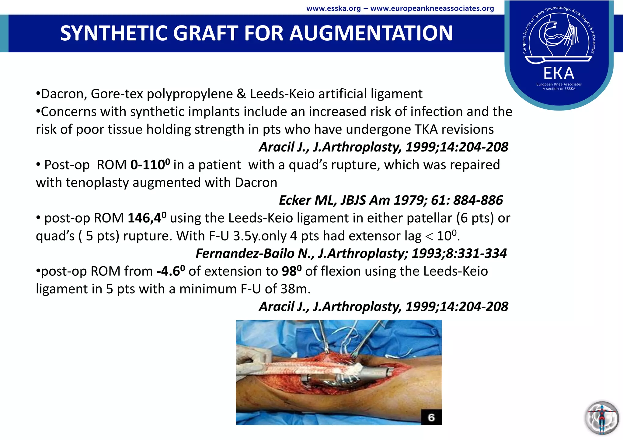 RECONSTRUCTION OF EXTENSOR MECHANISM IN TKA | PDF