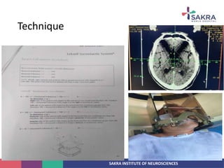 Stereotactic brain biopsy | PPTX