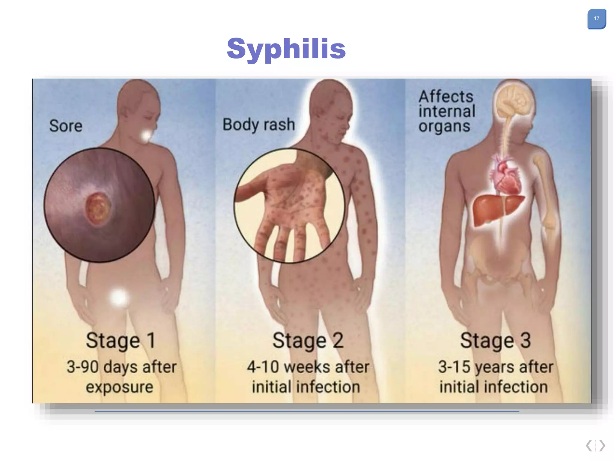 Sexually transmitted diseases management | PPTX